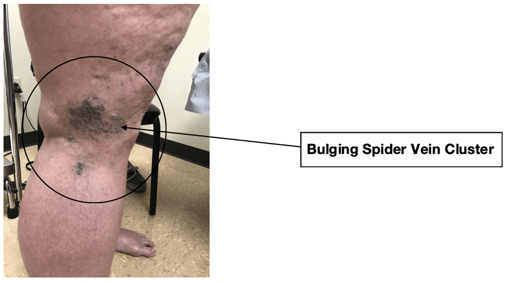 What to look for: Bulging spider vein cluster